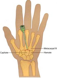 Parenteral Administration (Injectable)